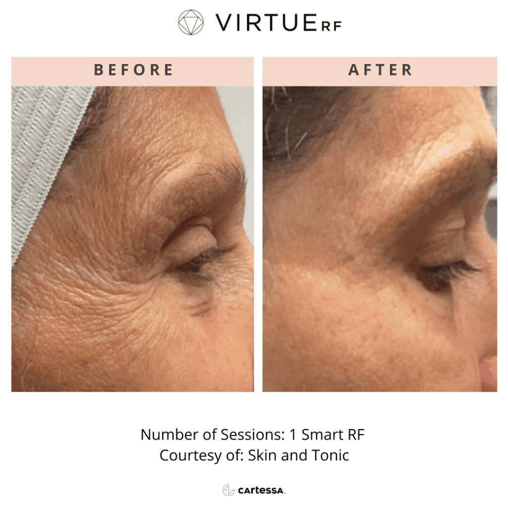 Virtue Micro-Needling